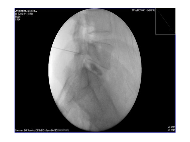 Intradiscal ozone and trans foraminal injections | PPT