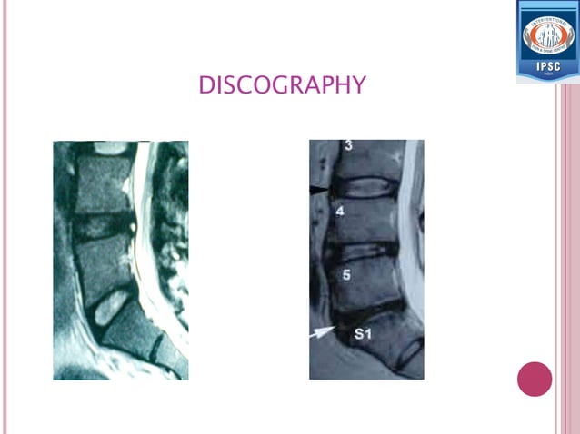 Intradiscal procedures current evidence | PPT
