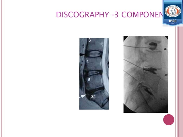 Intradiscal procedures current evidence | PPT