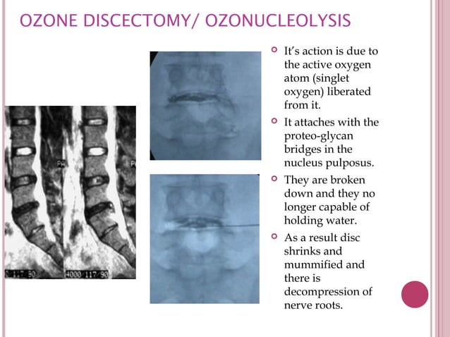 Intradiscal procedures current evidence | PPT