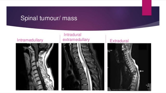 Intradural extramedullary mass - a case on MRI