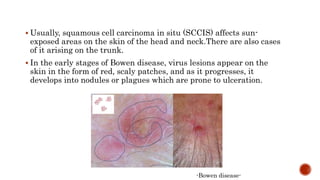 Intraepidermal Carcinoma.pptx in the children | PPT