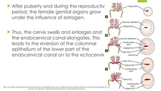 Intraepithelial Neoplasia of cervix in women | PPTX