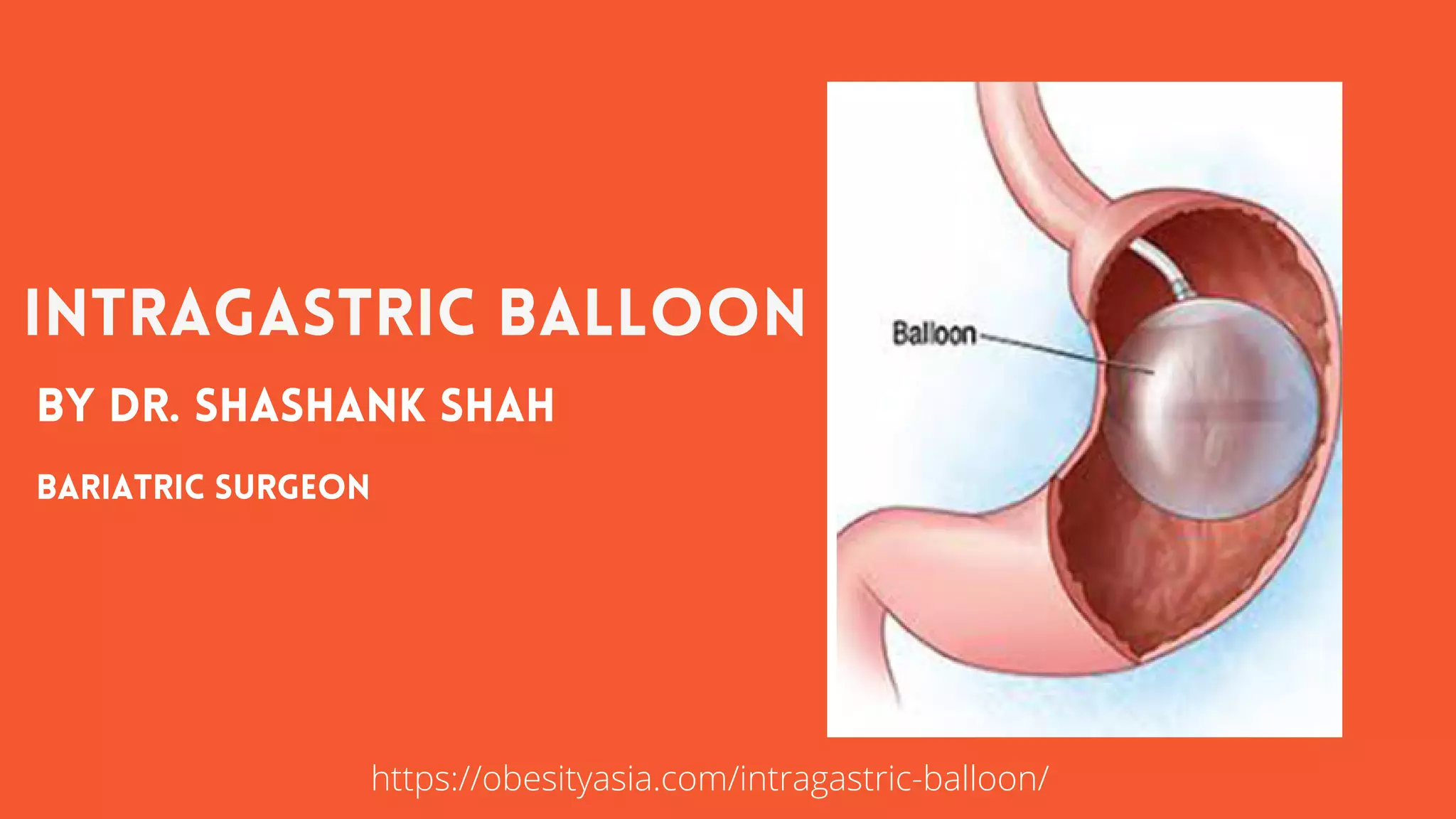 Intragastric balloon | PPT