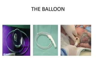 Intragastric balloons 2014 | PPTX