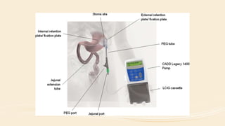 Intrajejunal Levodopa Infusion Therapy for Parkinson Disease | PPTX