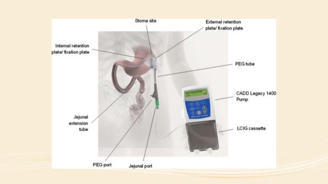 Intrajejunal Levodopa Infusion Therapy for Parkinson Disease