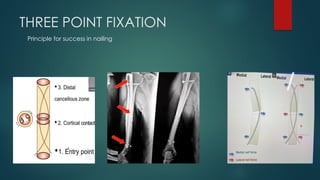 ROLE OF INTRAMEDULLARY NAILING IN FRACTURE.pptx