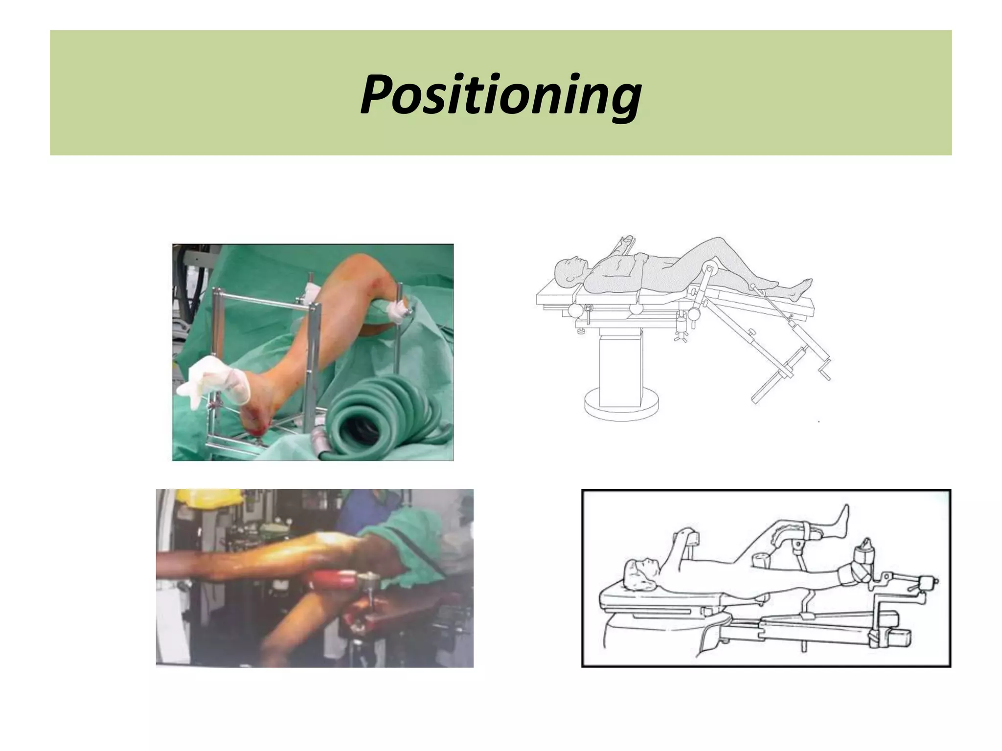 Intramedullary nailing of fractures.dr mohamed ashraf.HOD.govt TD ...