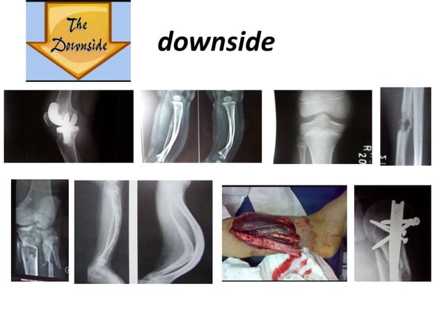 Intramedullary nailing of fractures.dr mohamed ashraf.HOD.govt TD ...