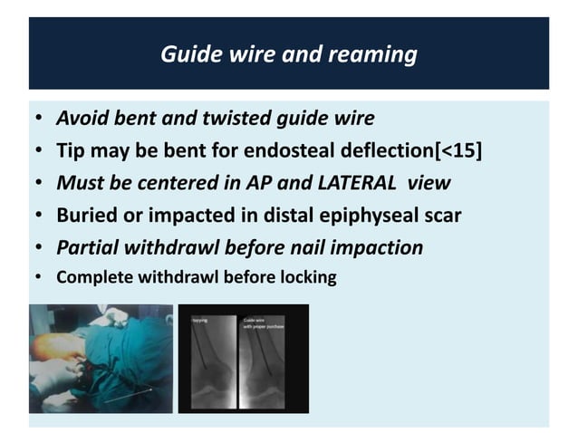 Intramedullary nailing of fractures.dr mohamed ashraf.HOD.govt TD ...