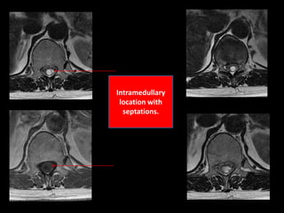 Intramedullary tumors | PPTX