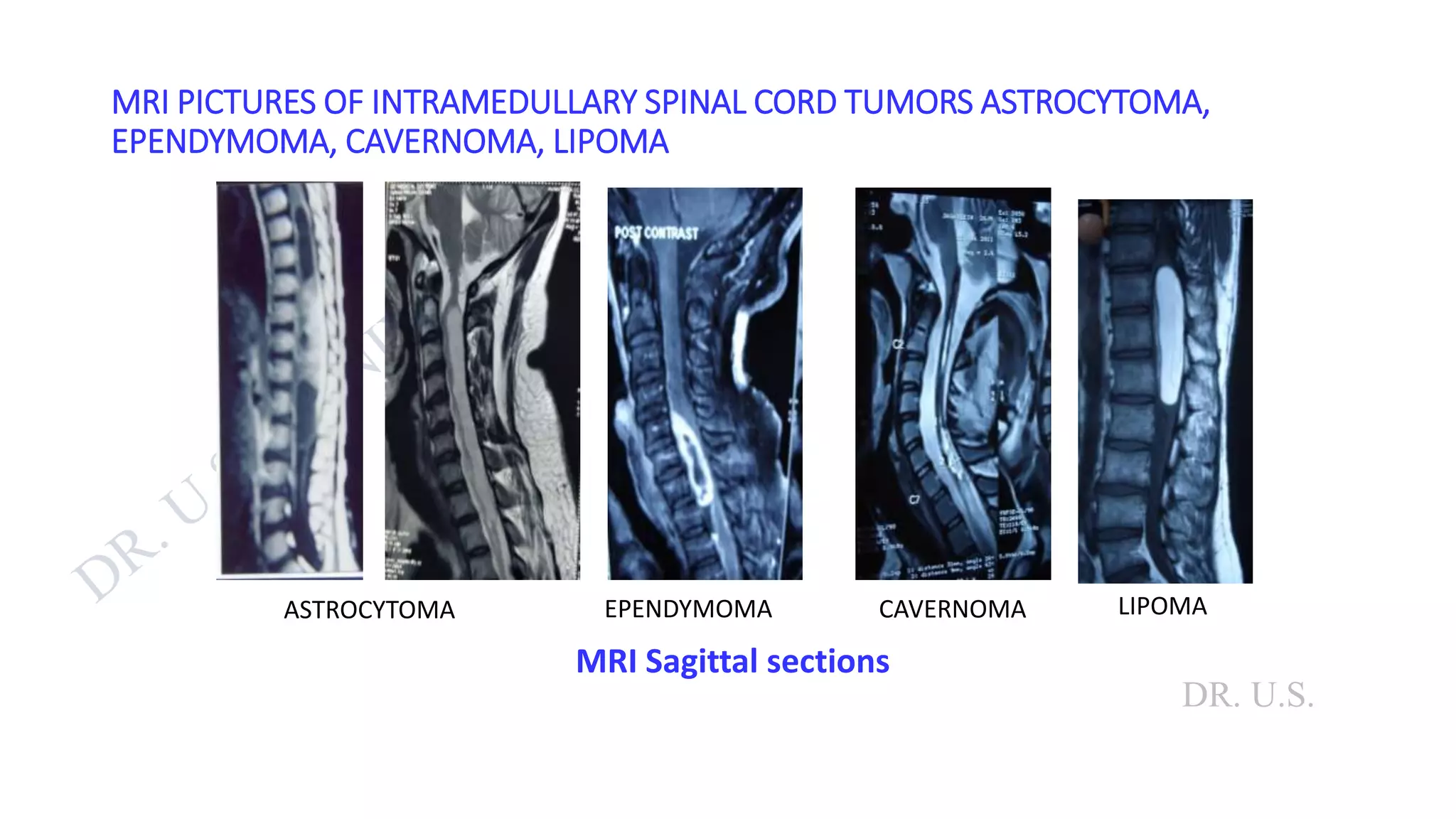 SPINAL INTRAMEDULLARY TUMORS - COMPARISON OF MRI, INTRAOPERATIVE ...