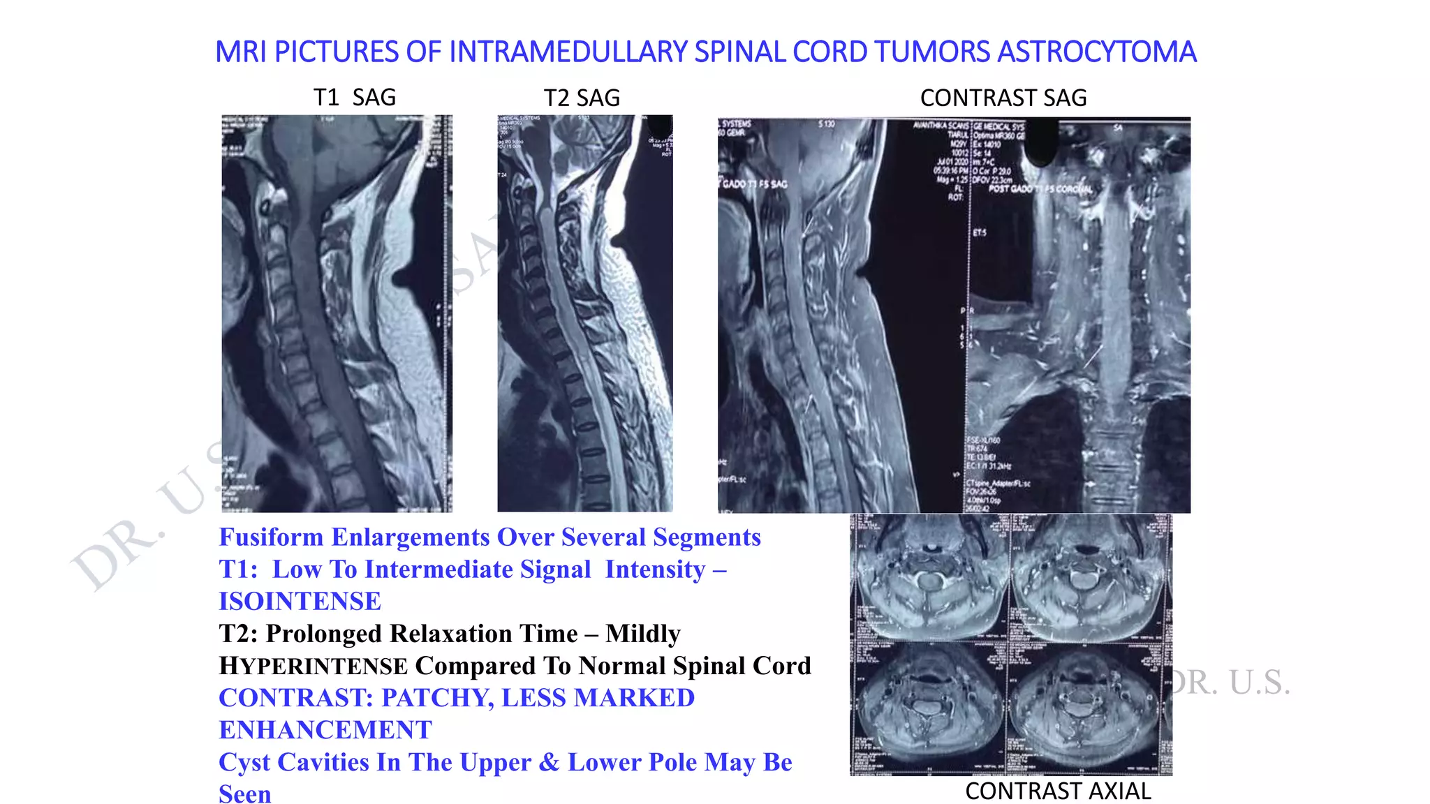 SPINAL INTRAMEDULLARY TUMORS - COMPARISON OF MRI, INTRAOPERATIVE ...