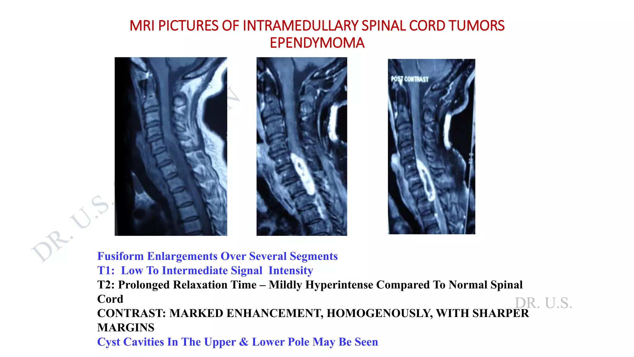 SPINAL INTRAMEDULLARY TUMORS - COMPARISON OF MRI, INTRAOPERATIVE CHARACTERISTICS | PPT
