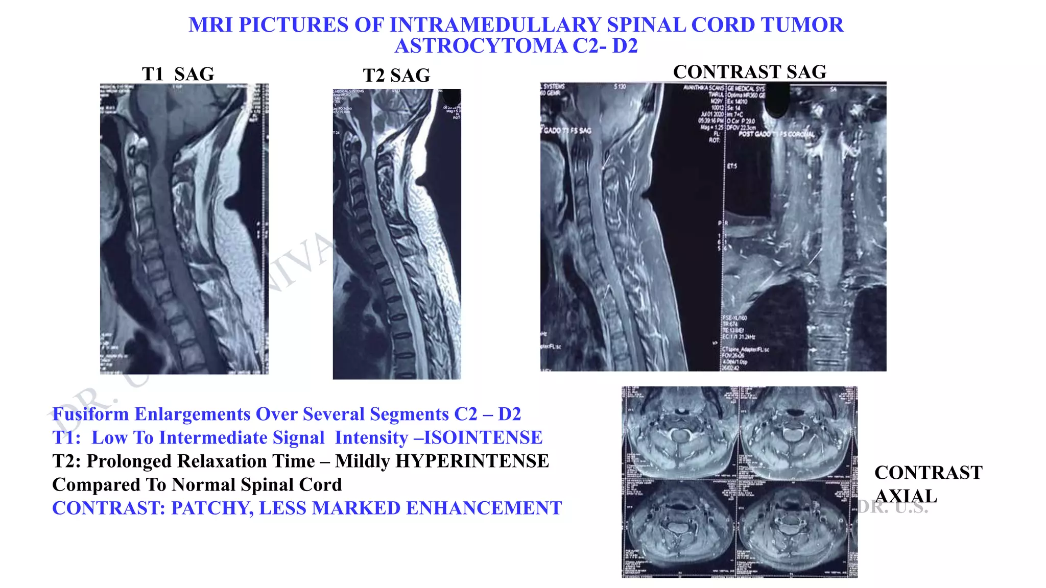 INTRAMEDULLARY SPINAL CORD ASTROCYTOMA SURGICAL STEPS | PPTX