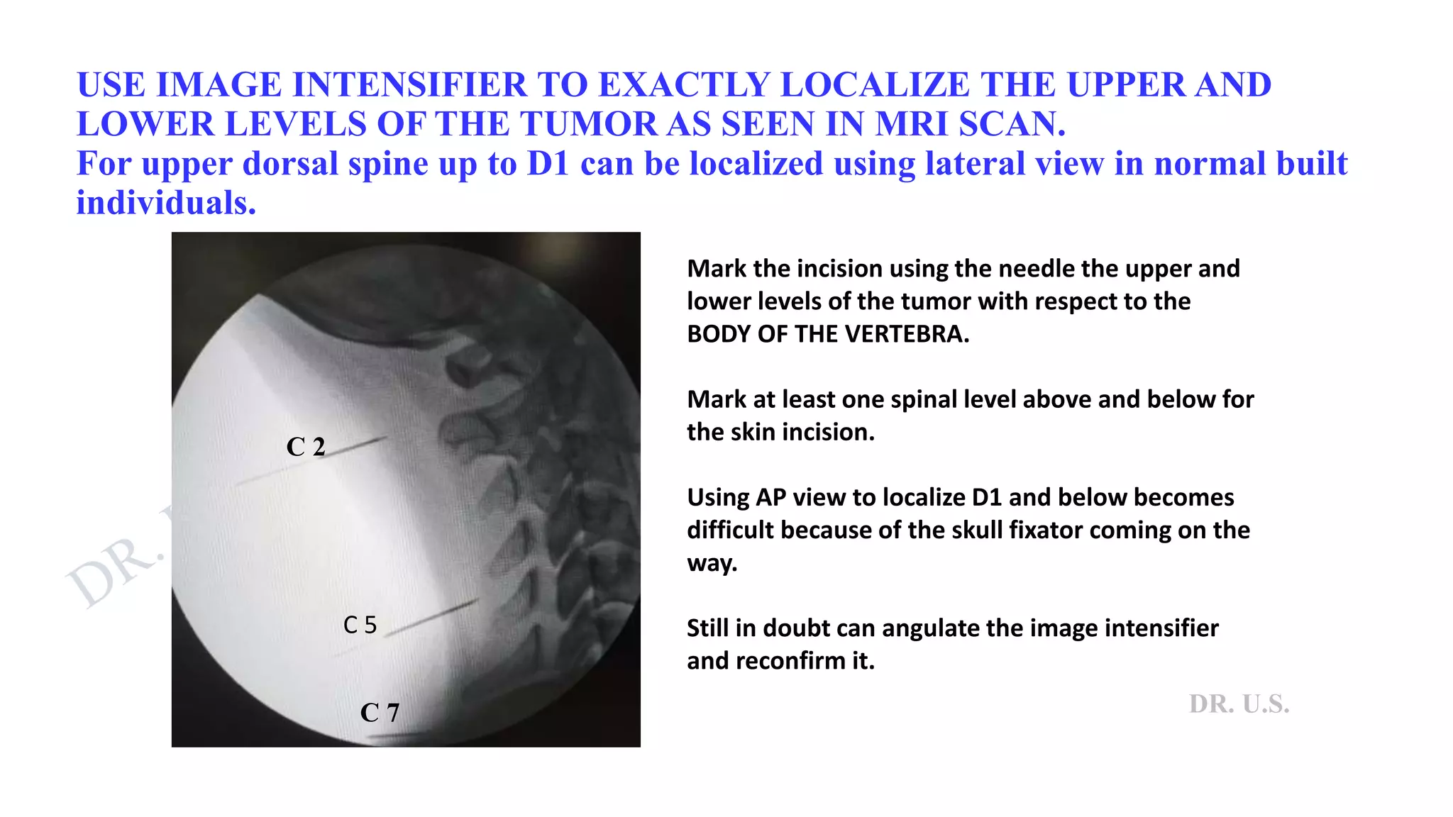 INTRAMEDULLARY SPINAL CORD ASTROCYTOMA SURGICAL STEPS | PPTX