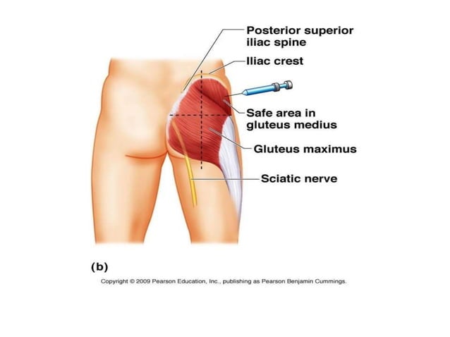 INTRAMUSCULAR INJECTION.pptx | Physical Therapy | Wellness