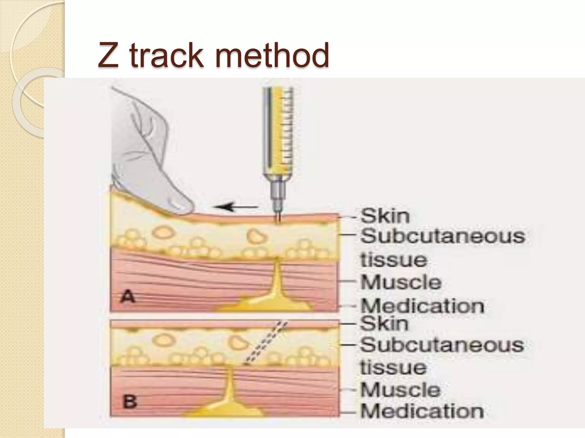 Intramuscular Injection -common sites, procedure, complications | PPTX