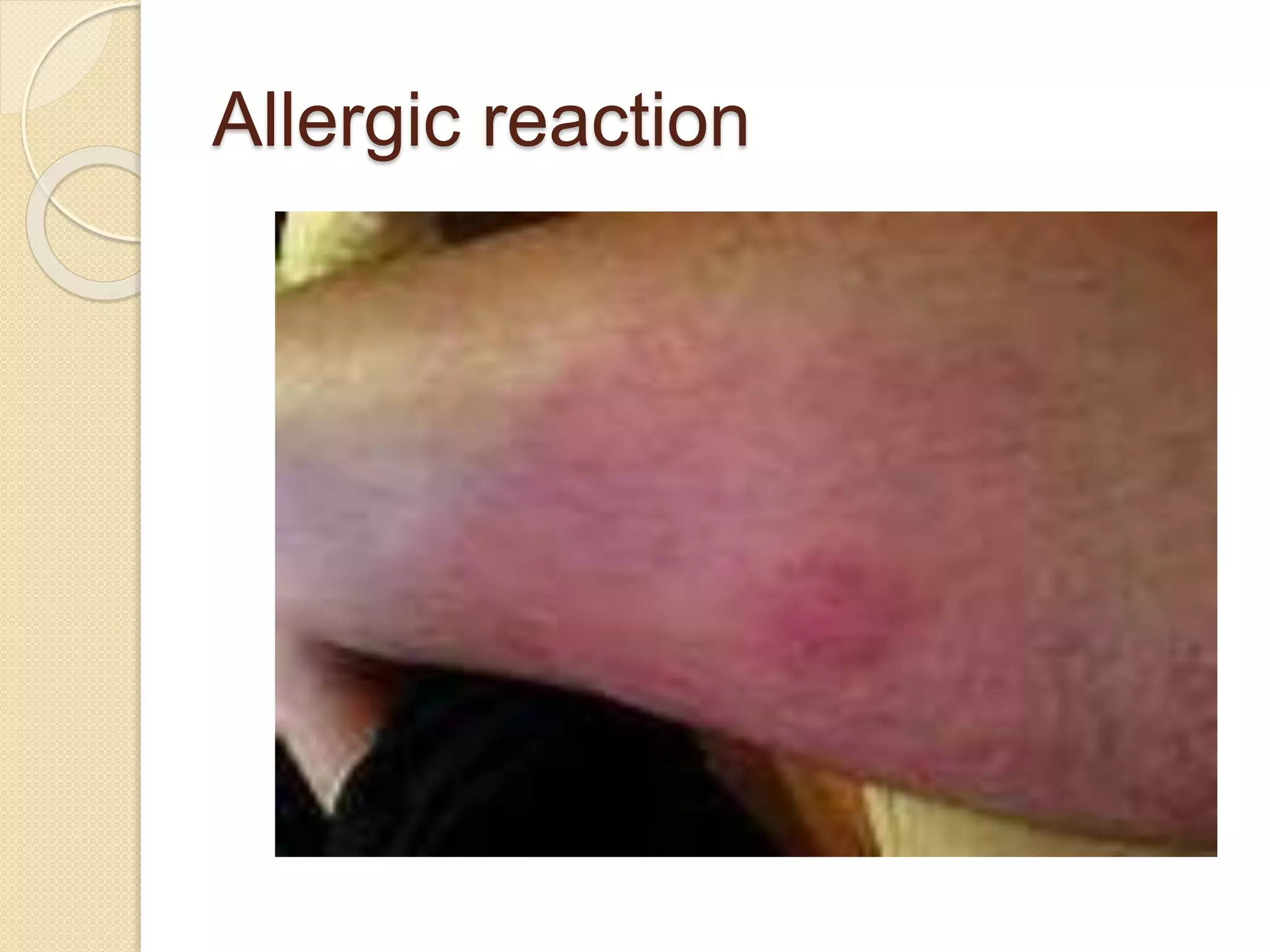 Intramuscular Injection -common sites, procedure, complications | PPTX