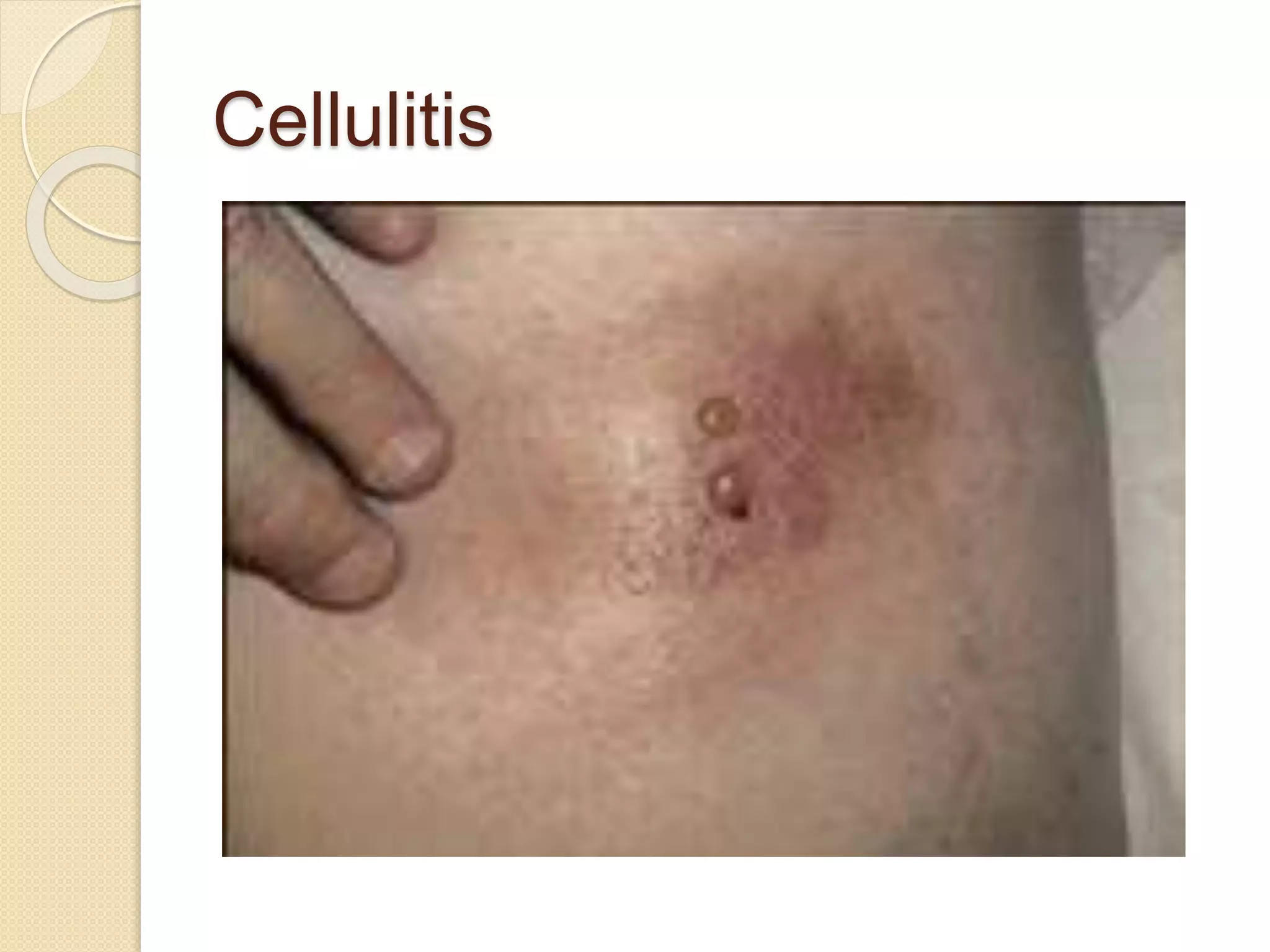 Intramuscular Injection -common sites, procedure, complications | PPTX