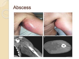 Intramuscular Injection -common sites, procedure, complications | PPTX