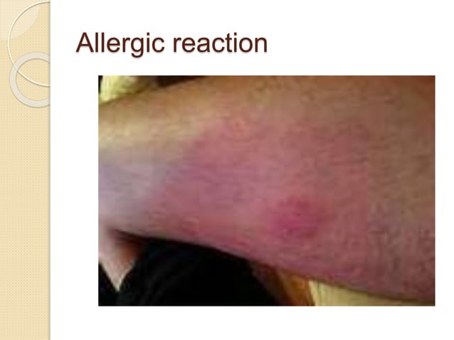 Intramuscular Injection -common sites, procedure, complications | PPTX