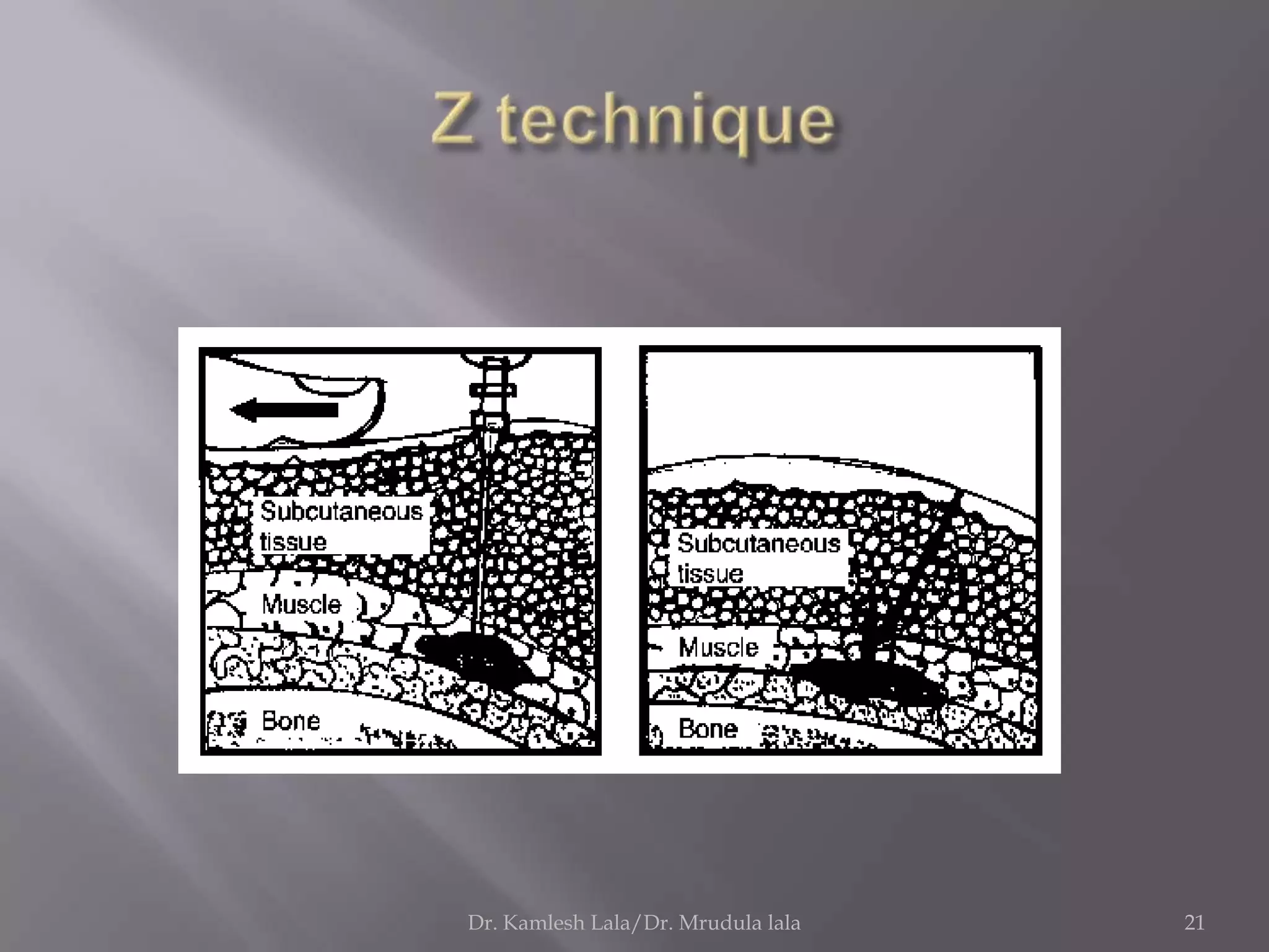 Intramuscular injection pain ppt | PPTX | Physical Therapy | Wellness