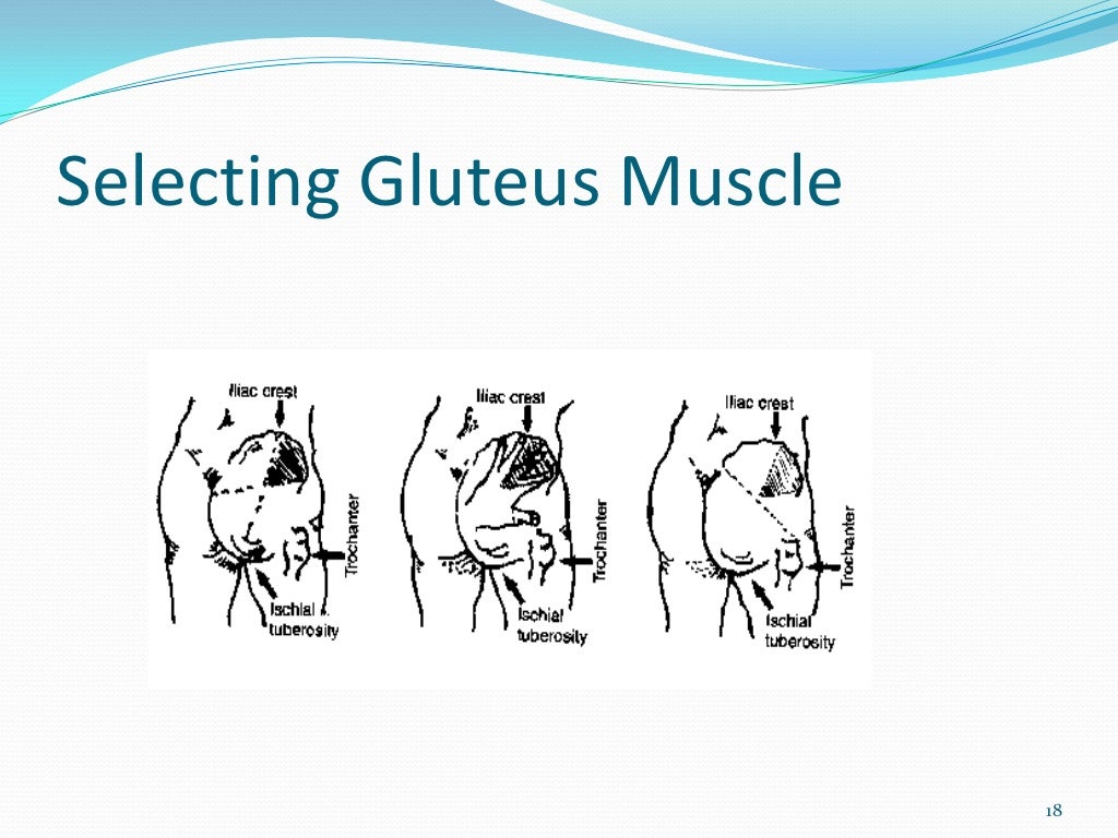 Intramuscular injection ppp