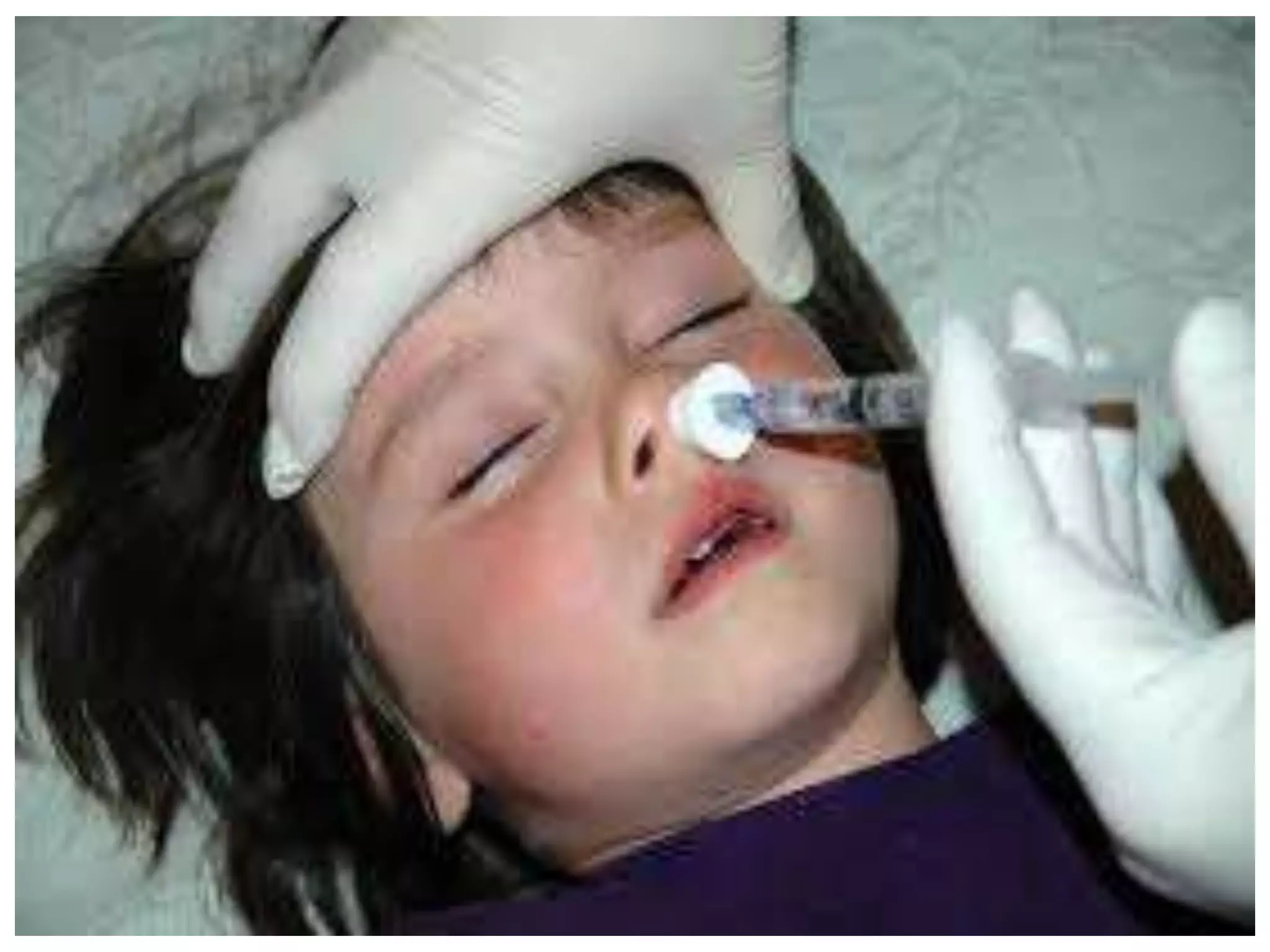 Intra nasal dd | PPTX