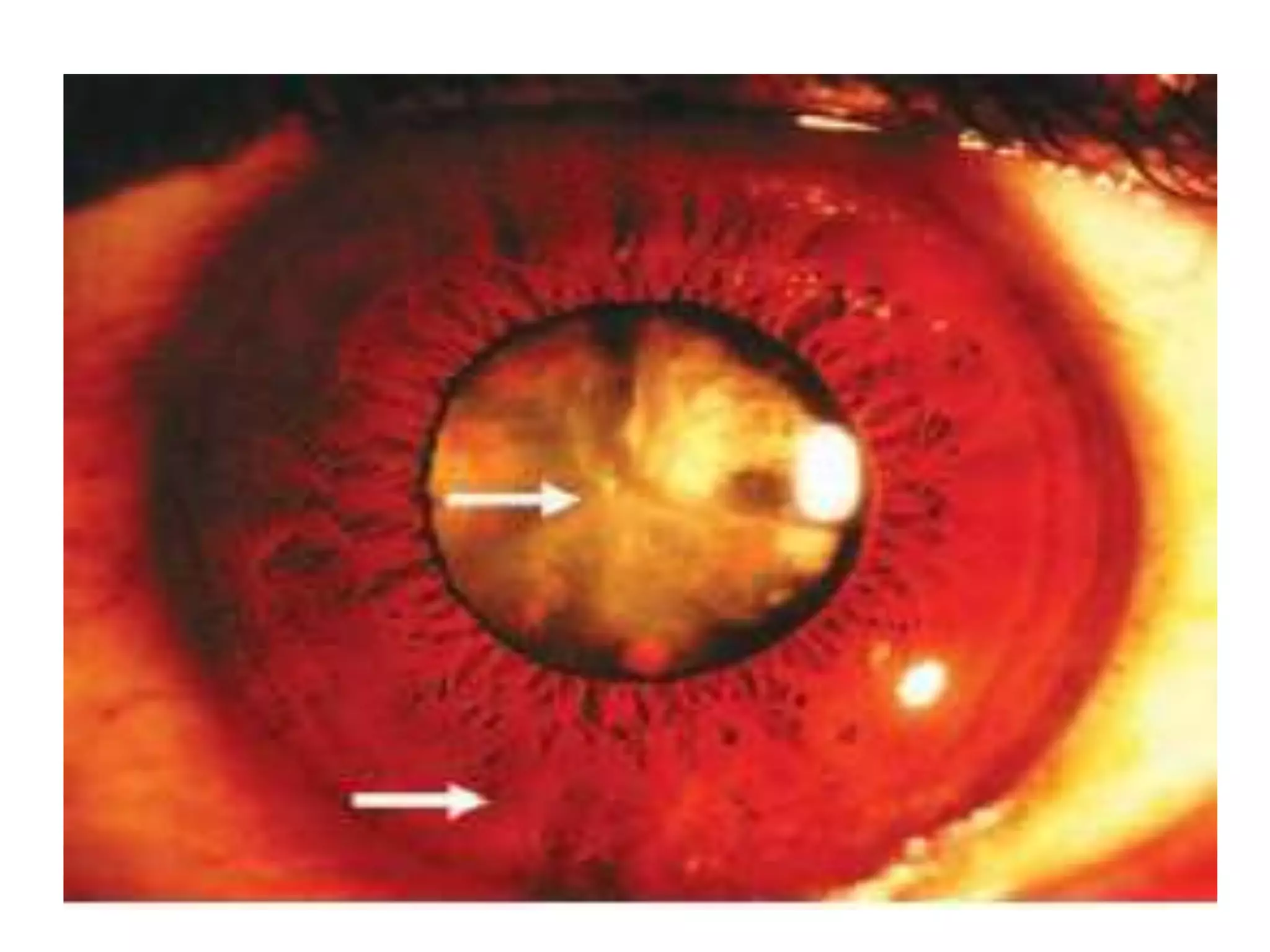 Intraocular foreign bodies | PPT