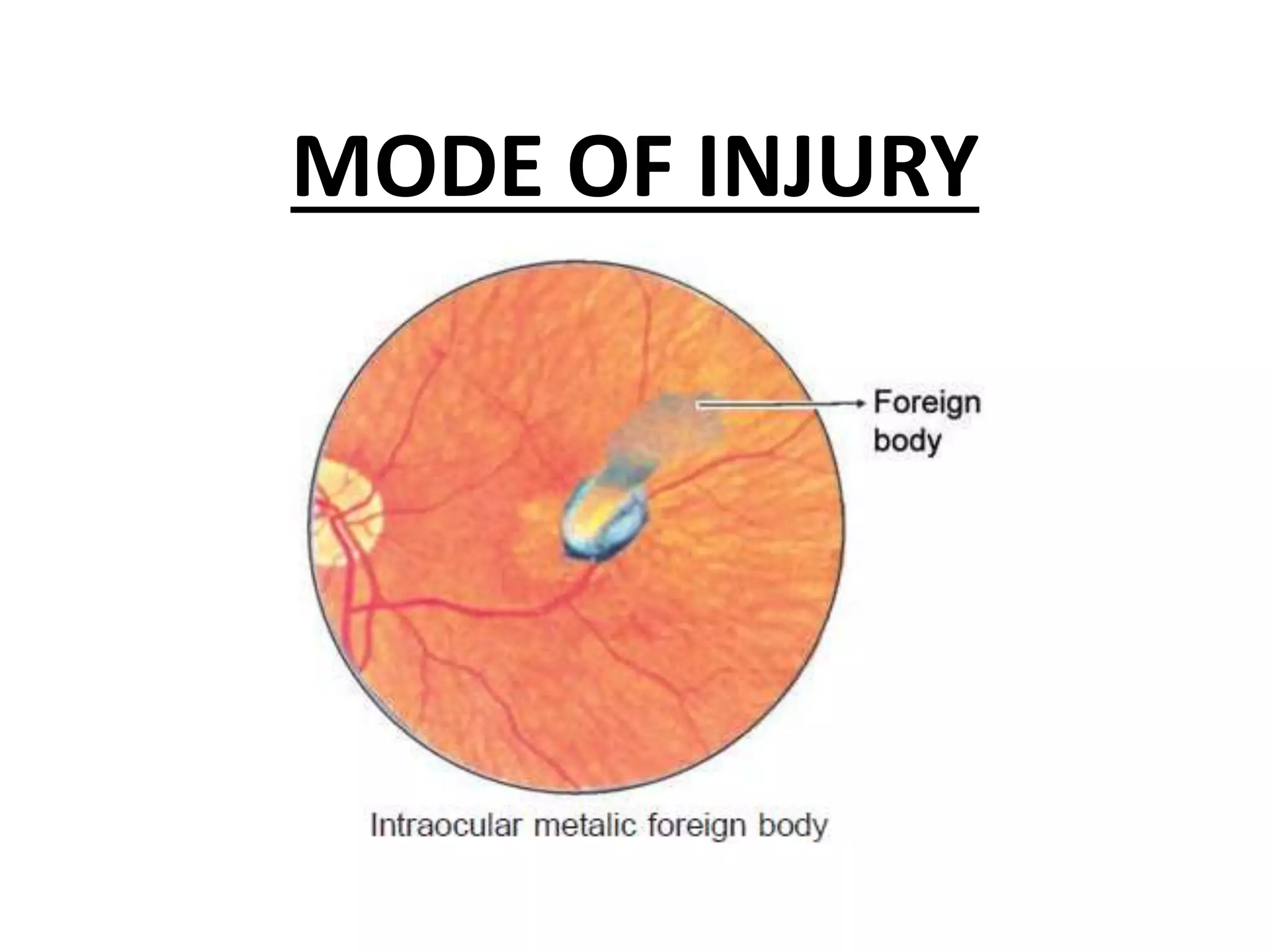 Intraocular foreign bodies | PPTX