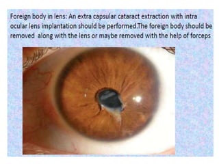 Intraocular foreign bodies | PPTX