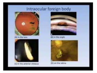 Intraocular foreign bodies | PPTX