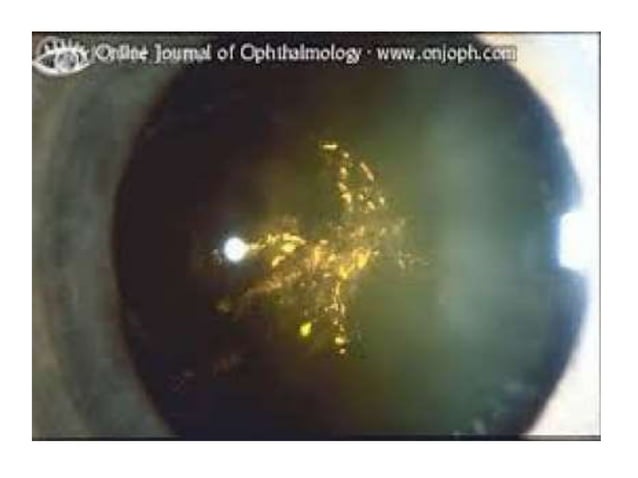 Intraocular foreign bodies | PPTX