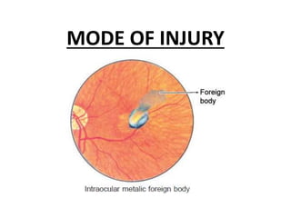Intraocular foreign bodies | PPTX