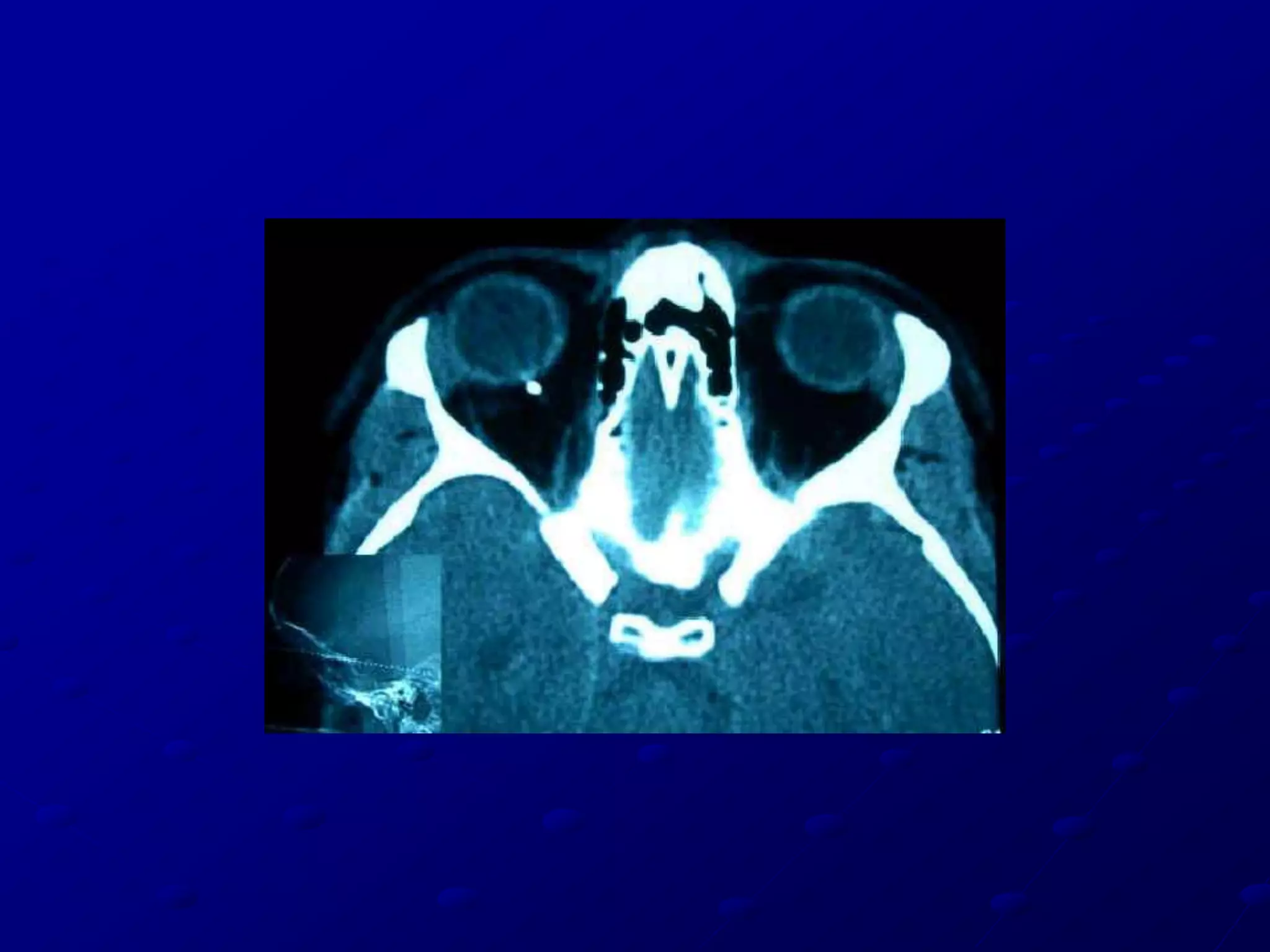Intraocular foreign bodies - AJAY DUDANI | PPT