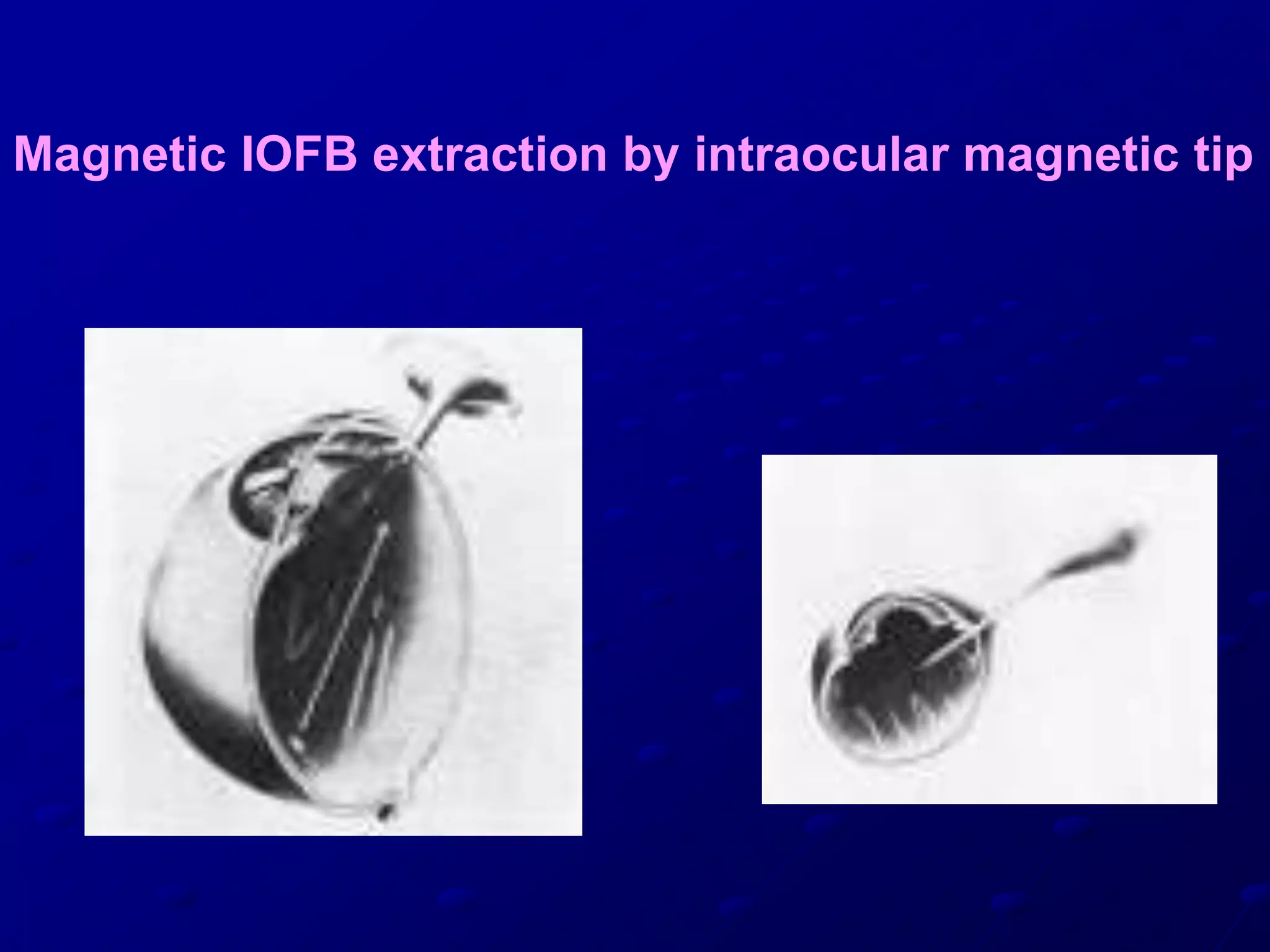 Intraocular foreign bodies - AJAY DUDANI | PPT