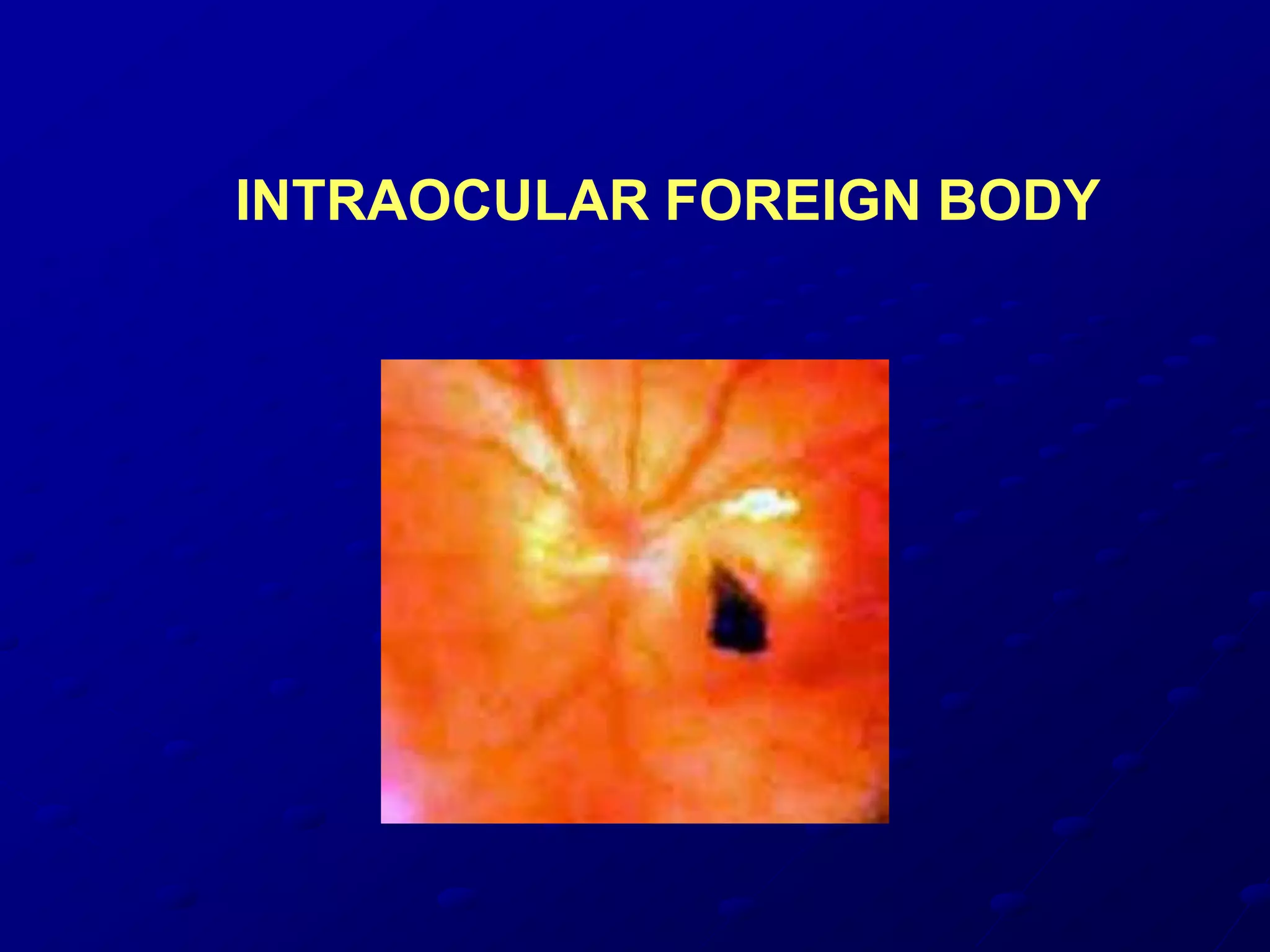 Intraocular foreign bodies - AJAY DUDANI | PPT