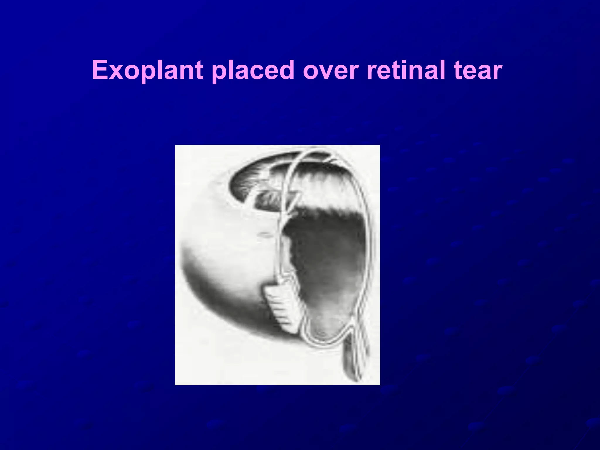 Intraocular foreign bodies - AJAY DUDANI | PPT
