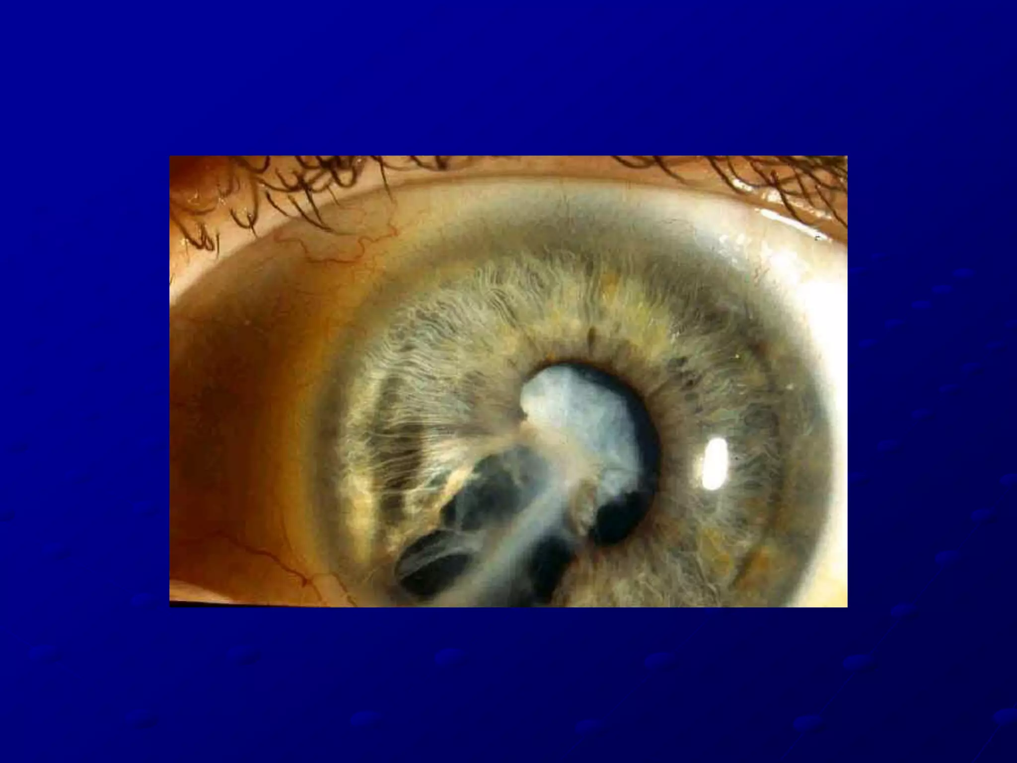 Intraocular foreign bodies - AJAY DUDANI | PPT
