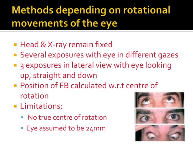 Intra ocular foreign body | PPTX | Eye and Vision Conditions | Diseases ...