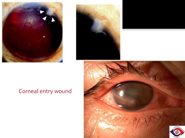 Intra ocular foreign body | PPTX | Eye and Vision Conditions | Diseases ...