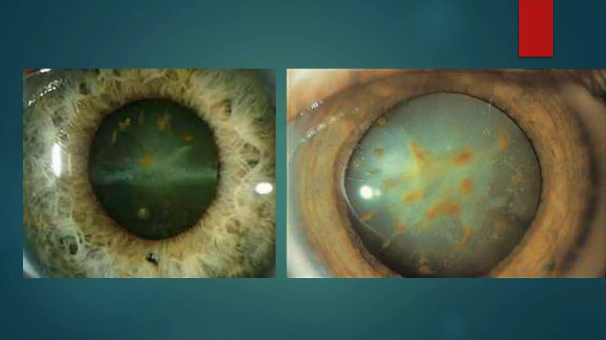 Intraocular foreign body | PPTX