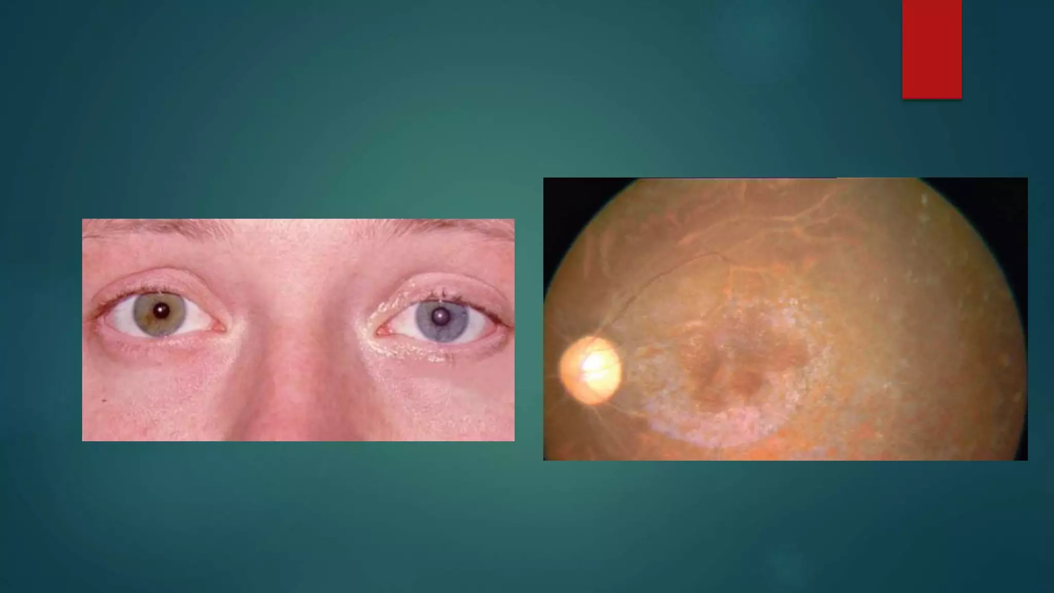 Intraocular foreign body | PPTX