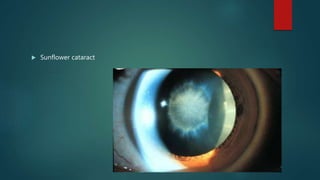 Intraocular foreign body | PPTX