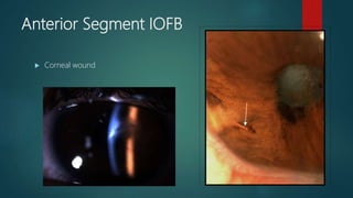Intraocular foreign body | PPTX