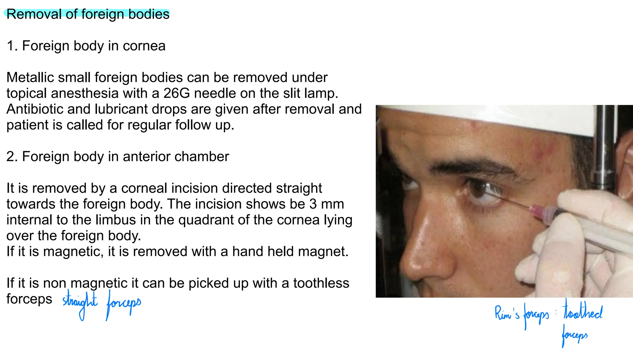 Intraocular foreign body removal techniques | PDF