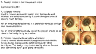 Intraocular foreign body removal techniques | PPT