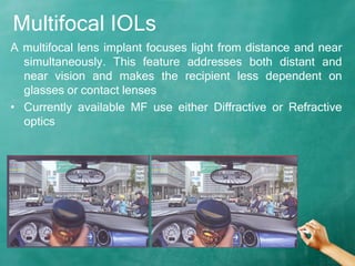 Intraocular lens | PDF